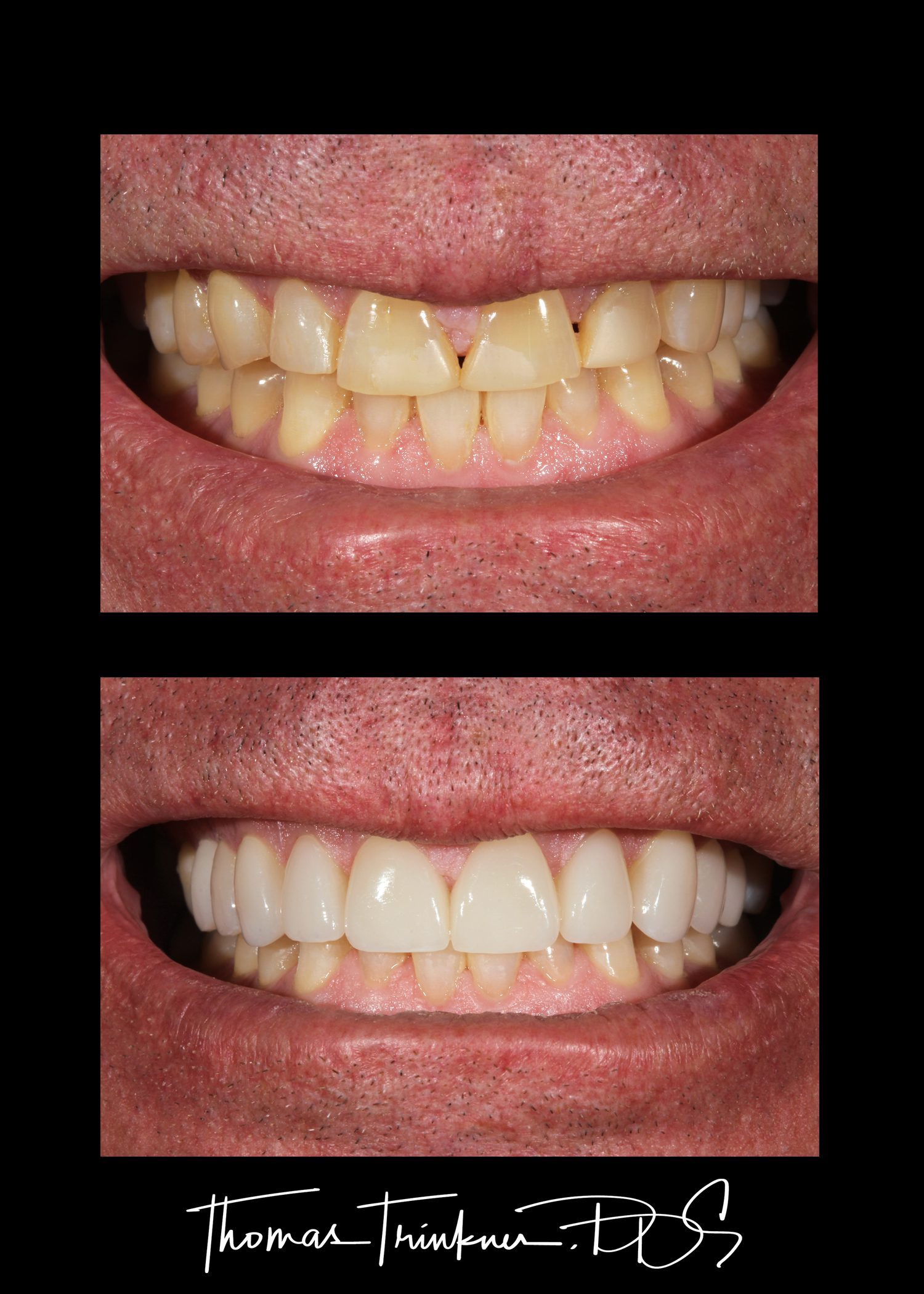 Worn & Broken Teeth Treatments in Columbia, SC